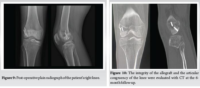 Osteochondral Allograft Transplantation for a Large Focal Osteochondral ...