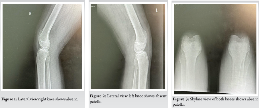 Congenital Absence of Bilateral Patella in an Active Military Personnel ...