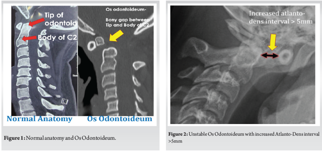 Philosophies and Surgical Techniques on Os Odontoideum Treatment with ...
