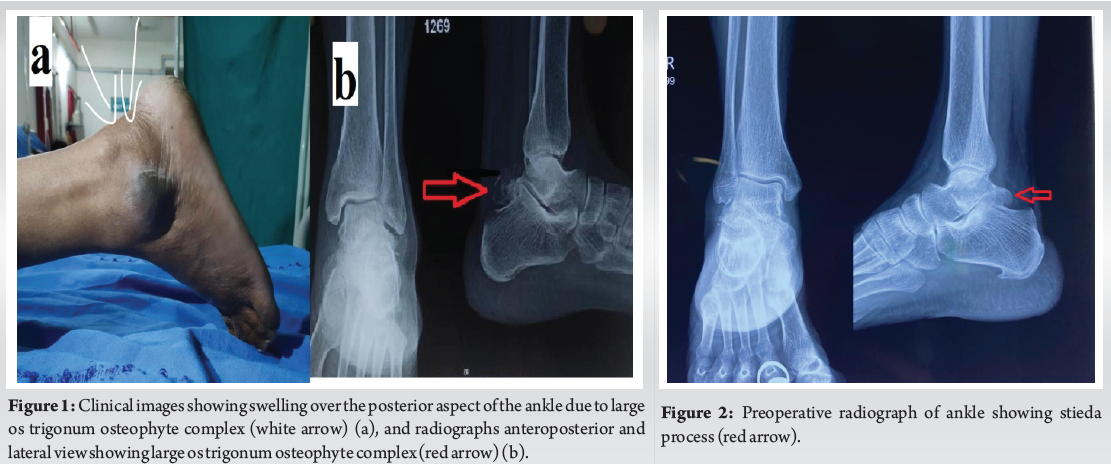 Arthroscopic Management of Posterior Ankle Impingement Syndrome – A ...