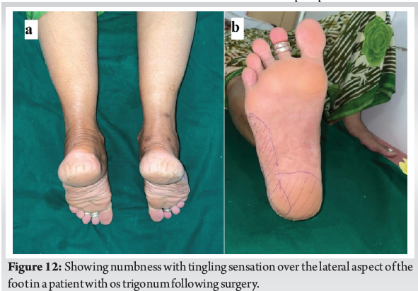 Arthroscopic Management of Posterior Ankle Impingement Syndrome – A ...