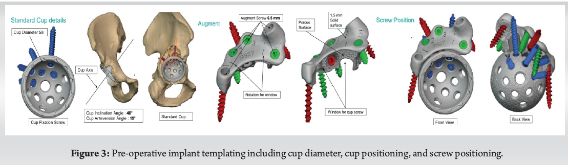 Custom-Made 3D-Printed Augments and Cages: An Effective Solution for ...