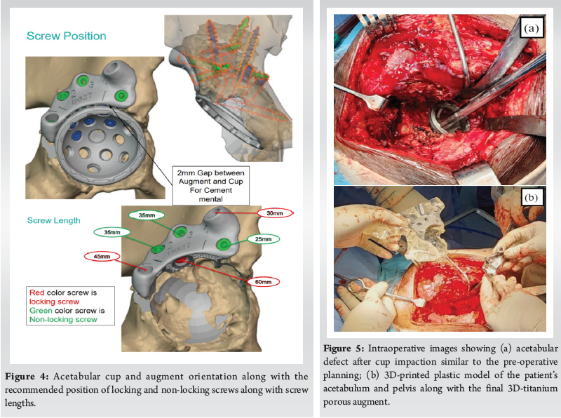 Custom-Made 3D-Printed Augments and Cages: An Effective Solution for ...