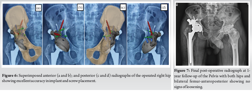 Custom-Made 3D-Printed Augments and Cages: An Effective Solution for ...