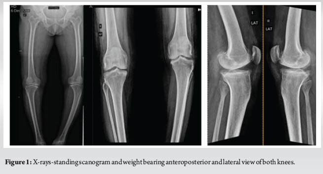 A Rare Complication of Sequential Bilateral Posterior Knee Dislocation ...