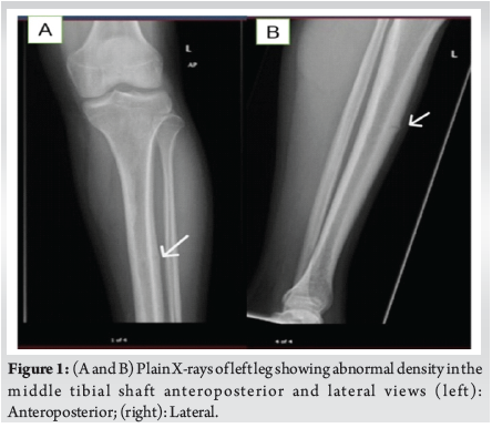 Diagnostic Pitfalls: Anterior Tibial Stress Fracture in a Professional ...