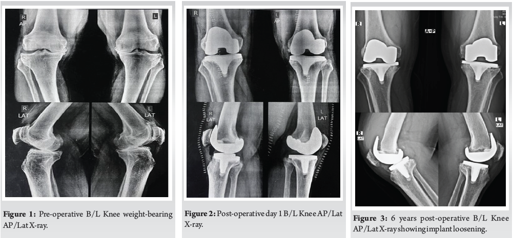 Polyethylene Insert Wear Leading to Early Aseptic Bilateral Total Knee ...