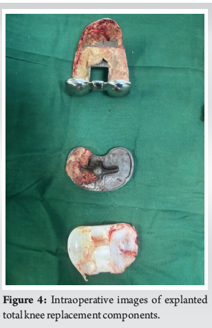 Polyethylene Insert Wear Leading to Early Aseptic Bilateral Total Knee ...