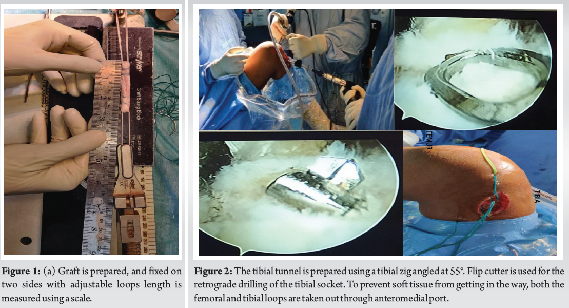 Functional Outcomes in ACL Reconstruction: A Randomized Controlled ...