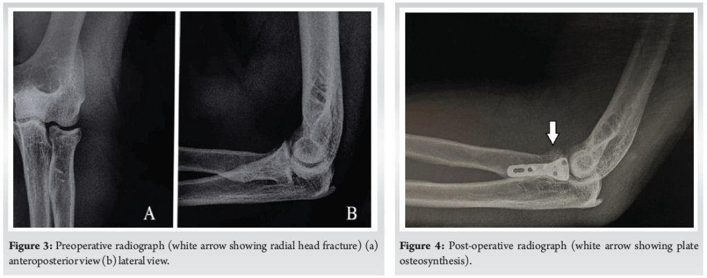 Functional Outcome of Radial Head Fracture Treated with Open Reduction ...