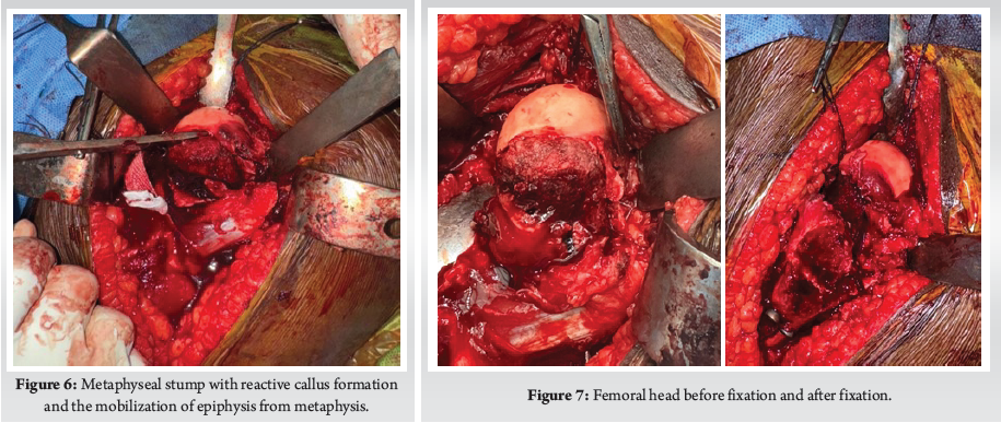 A Race against Time: Managing Acute Unstable Slipped Capital Femoral ...