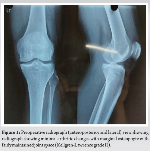 Incidental Arthroscopic Finding of Rheumatoid Arthritis in a Post ...