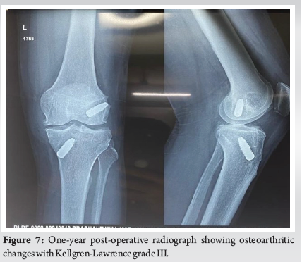 Incidental Arthroscopic Finding of Rheumatoid Arthritis in a Post ...