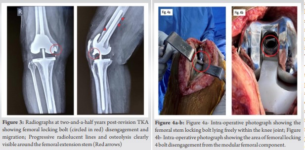 Unusual Failure of Modular TKA Prosthesis and Screw Migration following ...