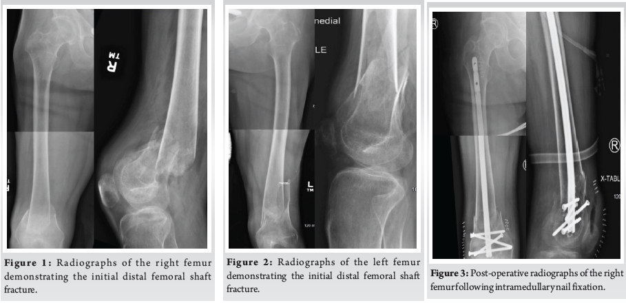 Treatment of Bilateral Distal Femoral Shaft Fractures in a Paraplegic ...