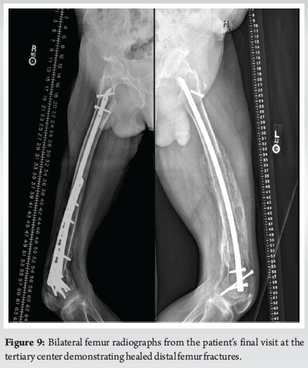 Treatment of Bilateral Distal Femoral Shaft Fractures in a Paraplegic ...