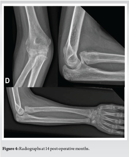 Elbow Dislocation Associated with Severely Displaced Radial Neck ...