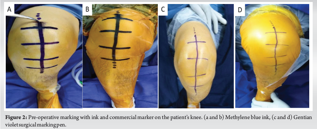 Cost-effective Skin Marking in Joint Replacement Surgery: A Comparative ...