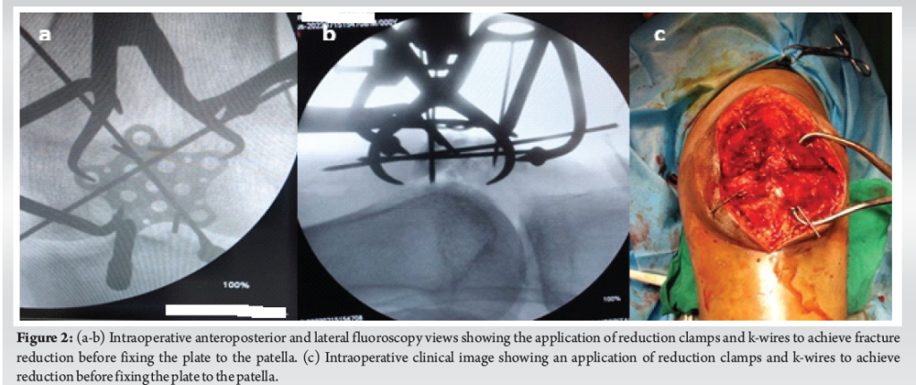 Outcome Analysis of Fixed angle Locking Plate in Comminuted Patella ...