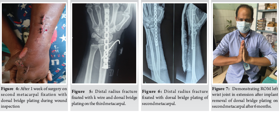 Dorsal Bridge Plating for Comminuted Distal Radius Fractures ...