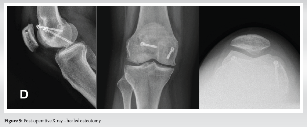 Chronic Flexion Patellar Dislocation with Femoral Patellofemoral ...