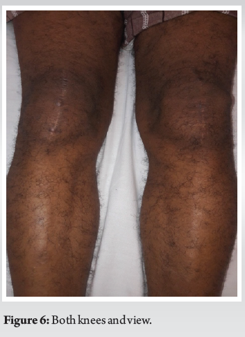 Bilateral Patellar Tendon Avulsion in End-Stage Renal Disease with G6 ...