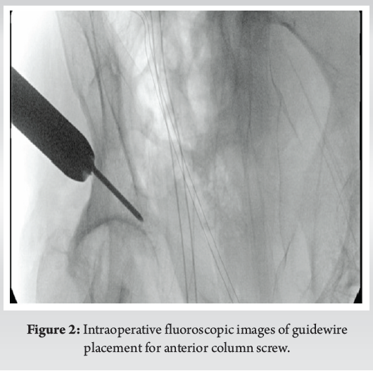 Fixation of Pubic and Acetabular Pathologic Fracture with Curvafix Nail ...
