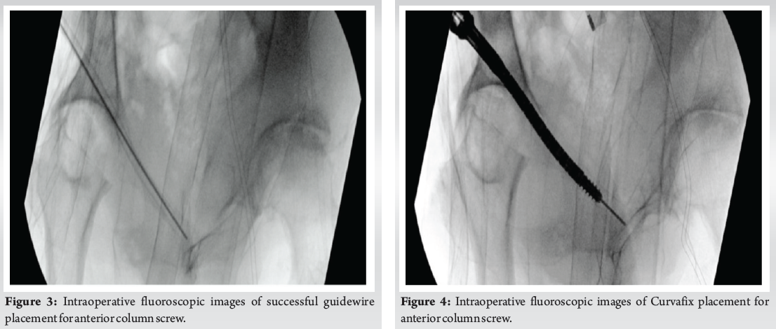 Fixation of Pubic and Acetabular Pathologic Fracture with Curvafix Nail ...