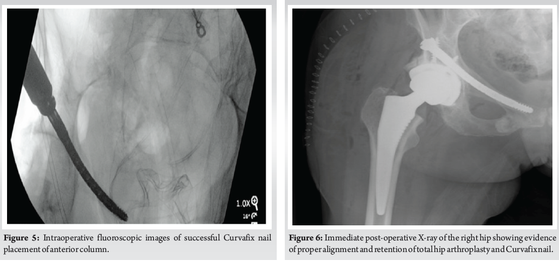 Fixation of Pubic and Acetabular Pathologic Fracture with Curvafix Nail ...