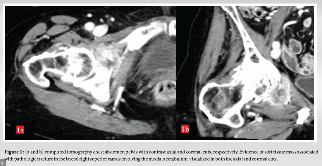 Fixation of Pubic and Acetabular Pathologic Fracture with Curvafix Nail ...