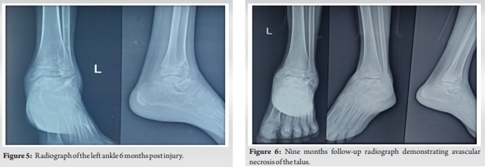Gunshot Injury to Distal Tibial Physis and Talus: A Case Report ...