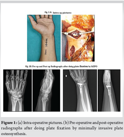 Functional Outcome of Distal Radius Fractures Managed by Minimally ...