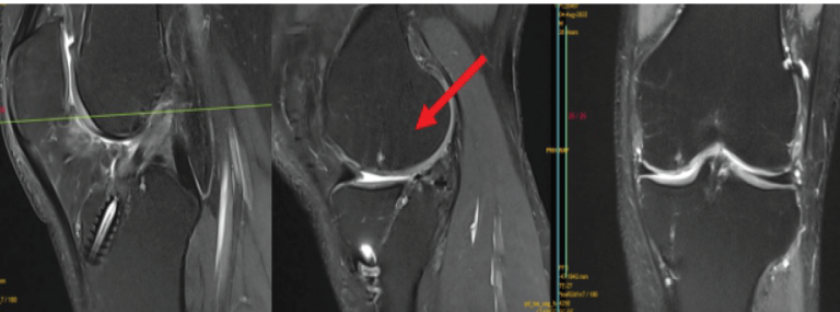 Single-Stage Anterior Cruciate Ligament (ACL) Reconstruction, Medial ...