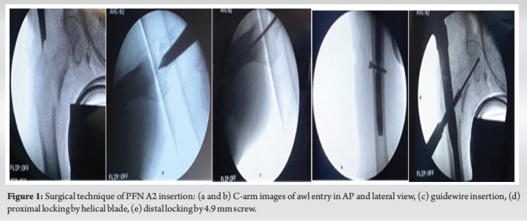 Comparative Study between Proximal Femoral Nail Anti Rotation and ...