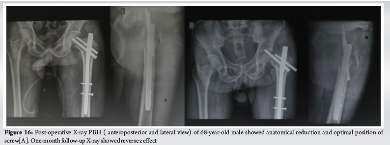 Comparative Study between Proximal Femoral Nail Anti Rotation and ...