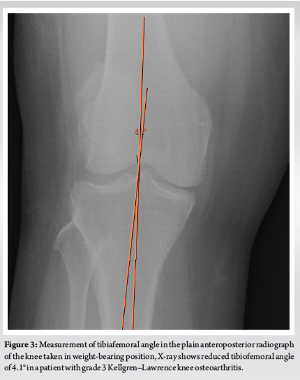 The Impact of Pes Planus on Knee Function and Its Association with ...