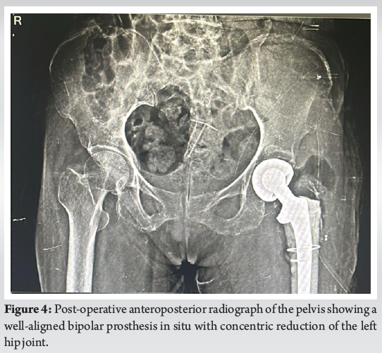 The Price of Poor Cementing: A Case Report On Chronic Hip Dislocation ...