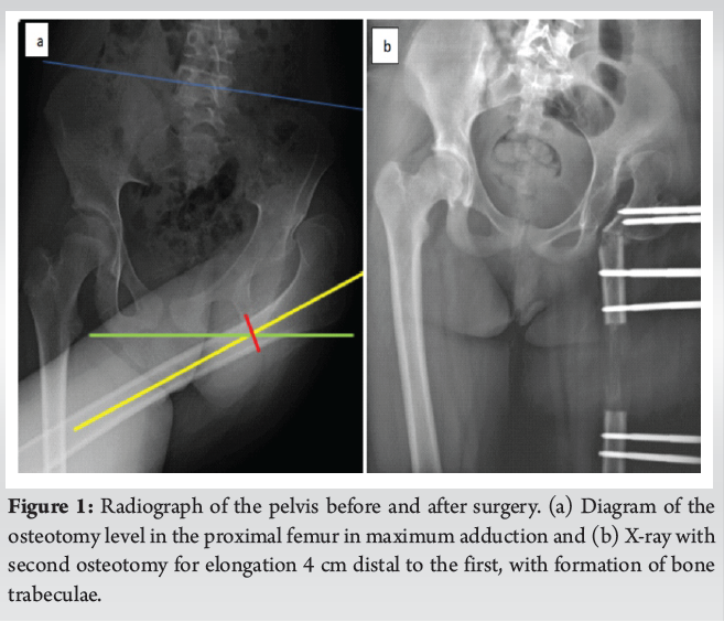 Modification of Pelvic Support Osteotomy Technique in Patients with ...