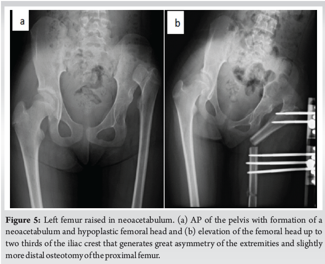 Modification of Pelvic Support Osteotomy Technique in Patients with ...
