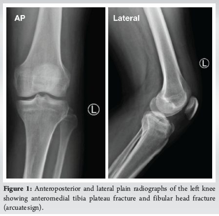Anteromedial Tibia Plateau Fracture without Significant Ligamentous ...