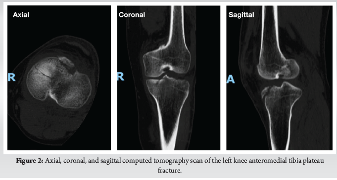 Anteromedial Tibia Plateau Fracture without Significant Ligamentous ...