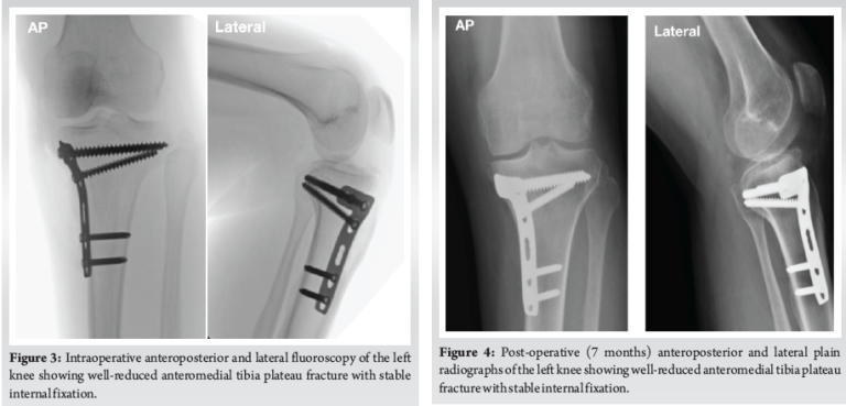 Anteromedial Tibia Plateau Fracture without Significant Ligamentous ...