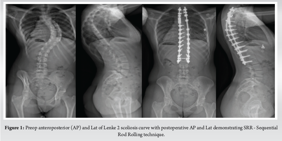 Sequential Rod Rolling for Surgical Correction of Lenke Type 2 ...