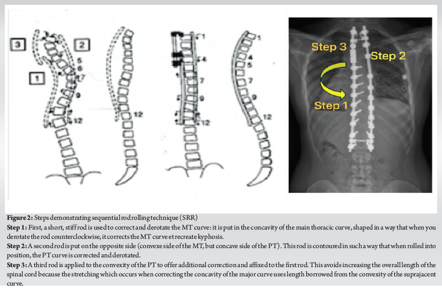 Sequential Rod Rolling for Surgical Correction of Lenke Type 2 ...
