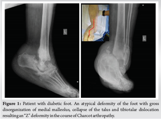 What the Physician Needs to Know about Charcot Arthropathy and Ankle ...