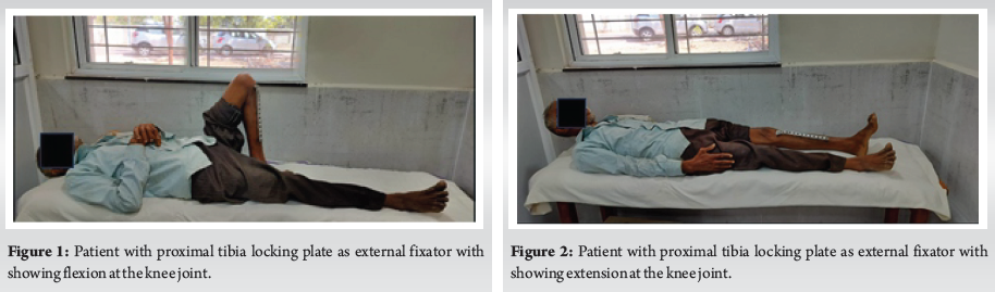 Externally Applied Metaphyseal Locking Plate: An Alternative to ...