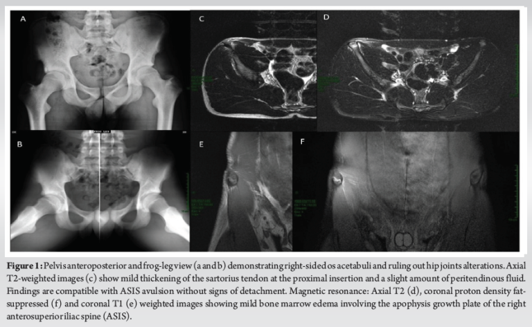 Magnetic Resonance Imaging in the Evaluation of Avulsion Injuries of ...