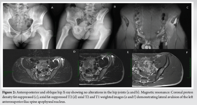 Magnetic Resonance Imaging in the Evaluation of Avulsion Injuries of ...