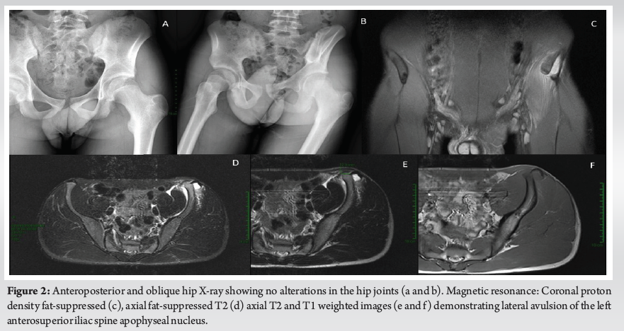 Magnetic Resonance Imaging in the Evaluation of Avulsion Injuries of ...