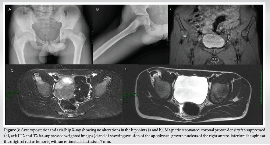 Magnetic Resonance Imaging in the Evaluation of Avulsion Injuries of ...